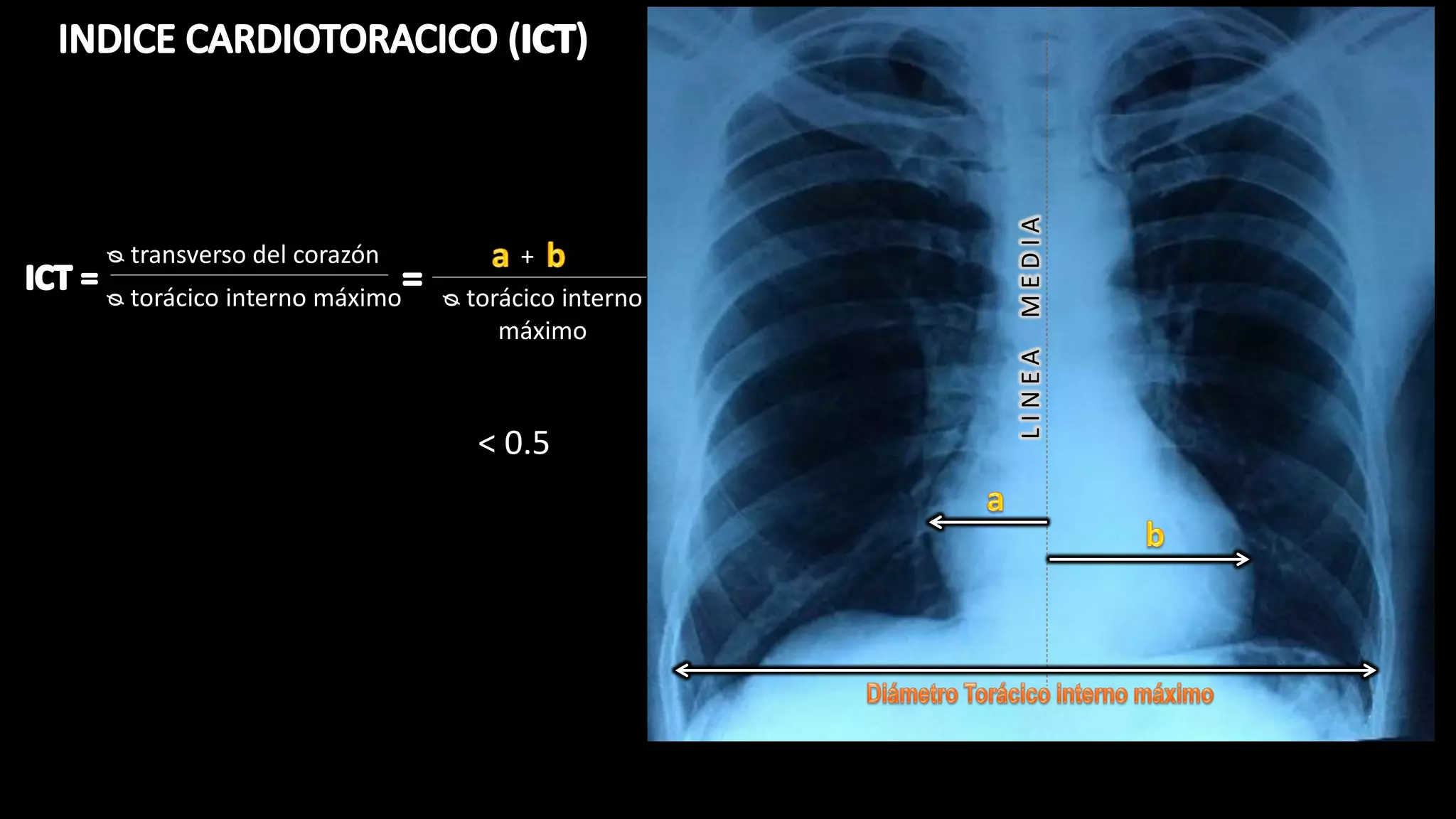 patologia rx tc rmn semiologia corazon art pulmonar y aorta | PPT