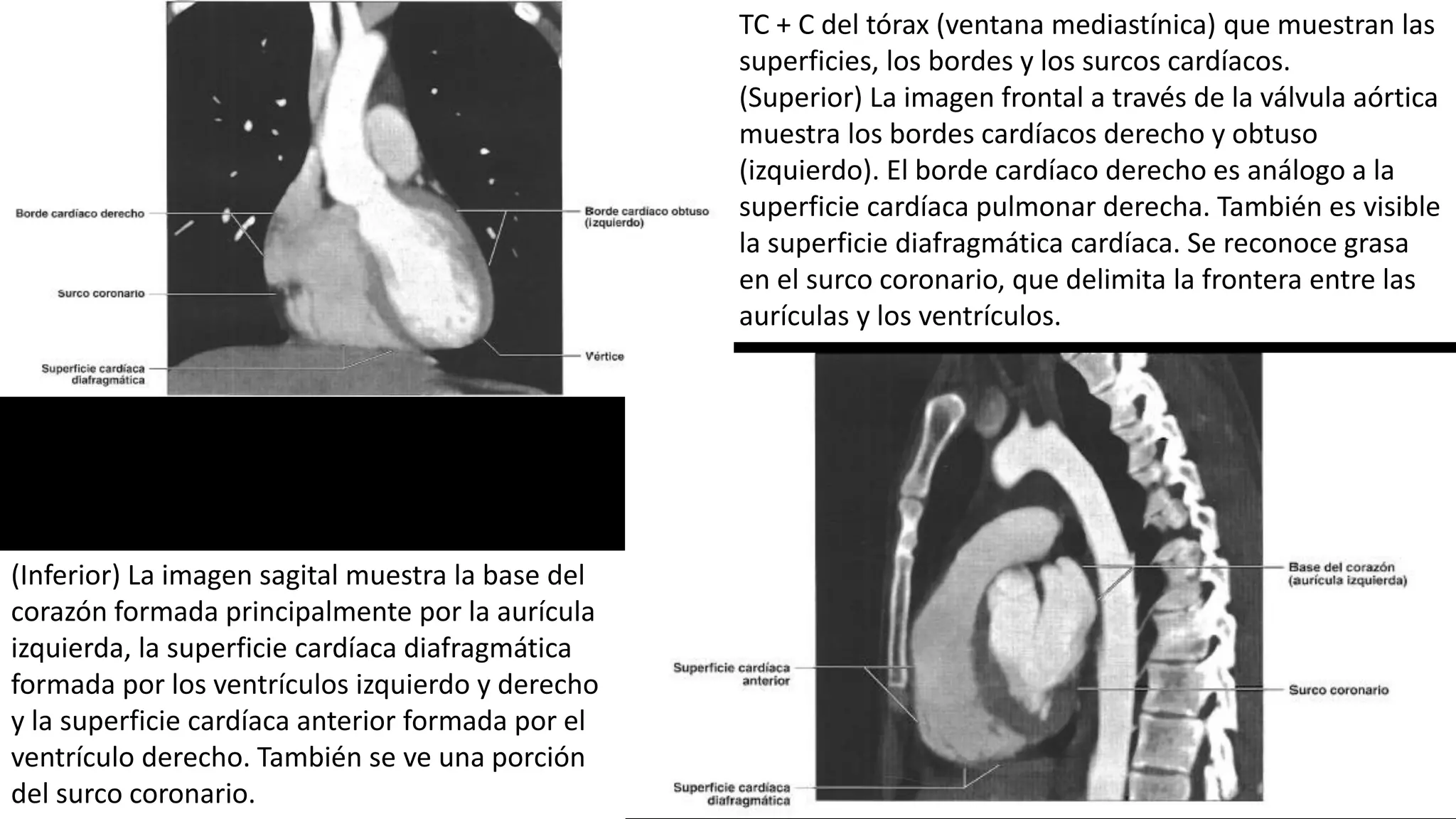 patologia rx tc rmn semiologia corazon art pulmonar y aorta | PPT