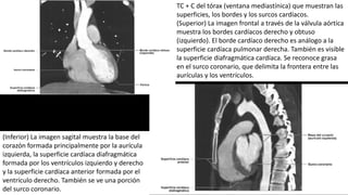 patologia rx tc rmn semiologia corazon art pulmonar y aorta | PDF