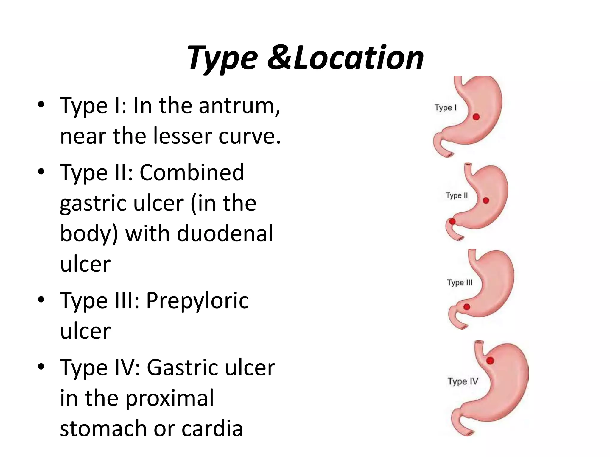 2 PEPTIC ULCER.pptx