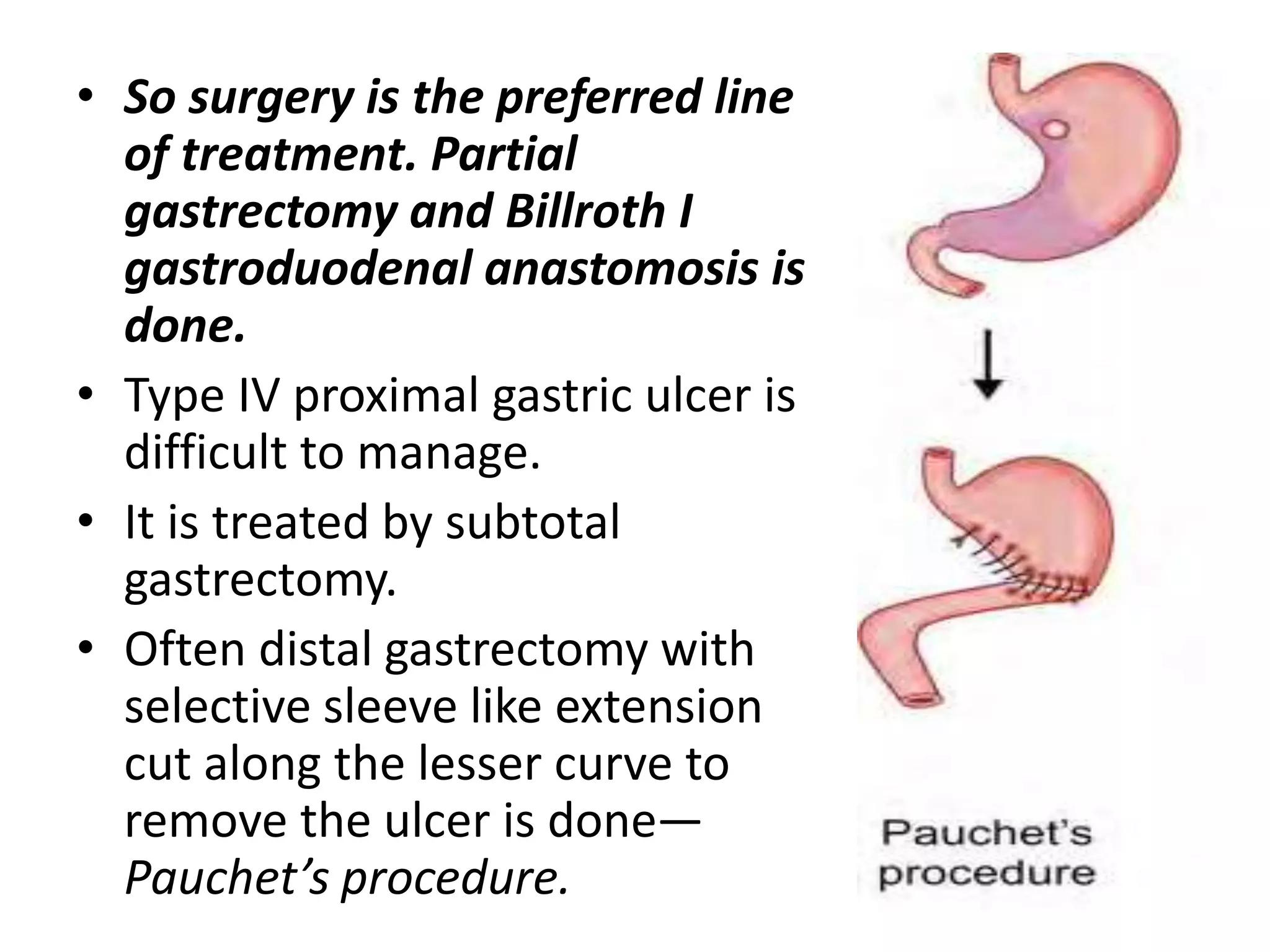 2 PEPTIC ULCER.pptx