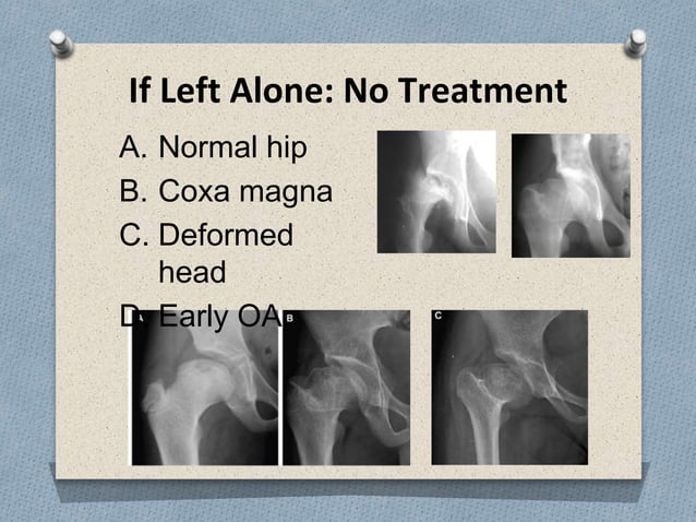 LCPD Perthes'_ management | PPTX