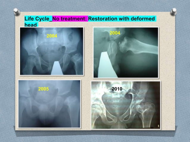 LCPD Perthes'_ management | PPTX