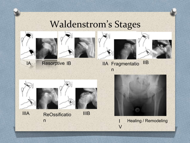 LCPD Perthes'_ management | PPTX