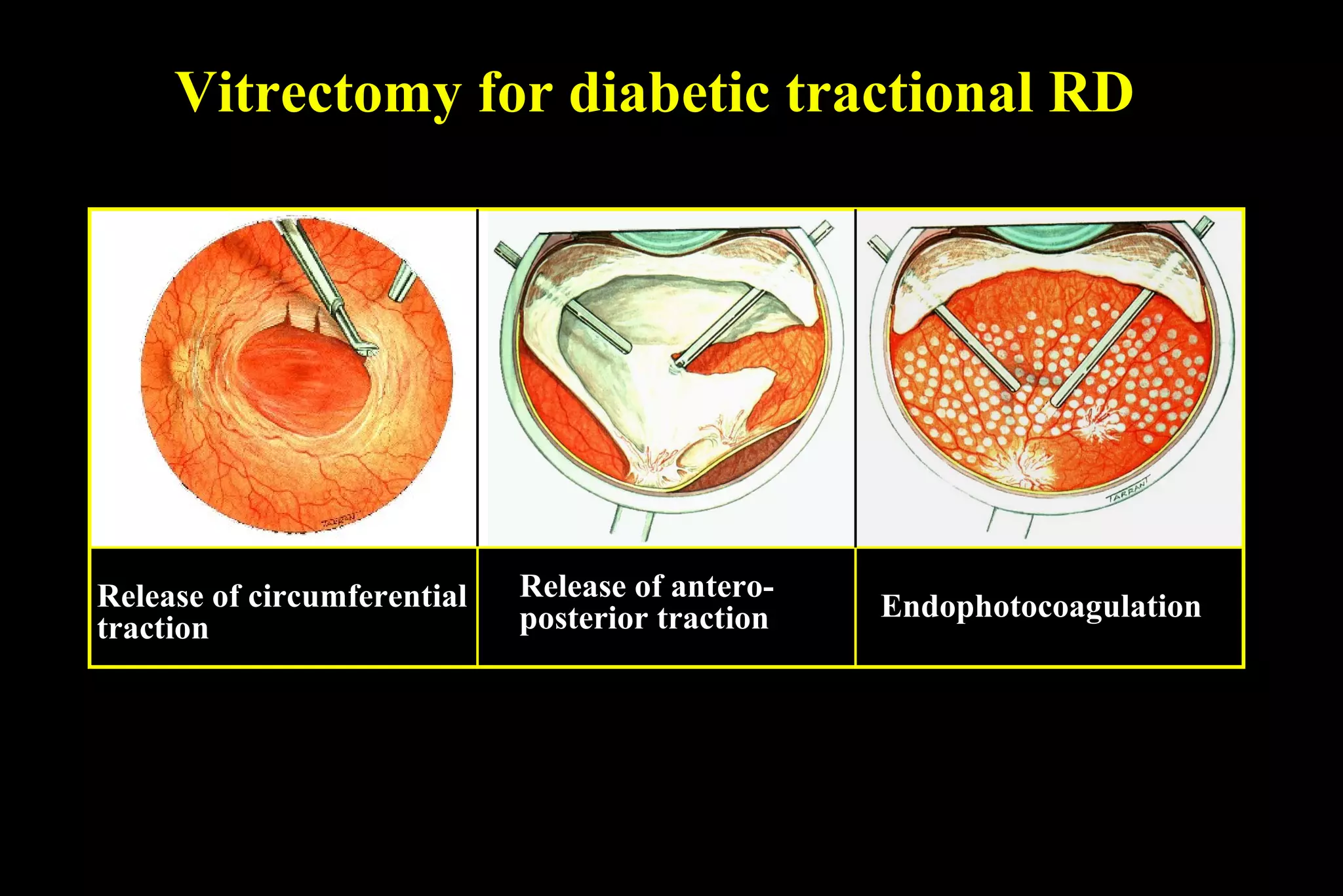 41 principles retinal detachment surgery | PPT