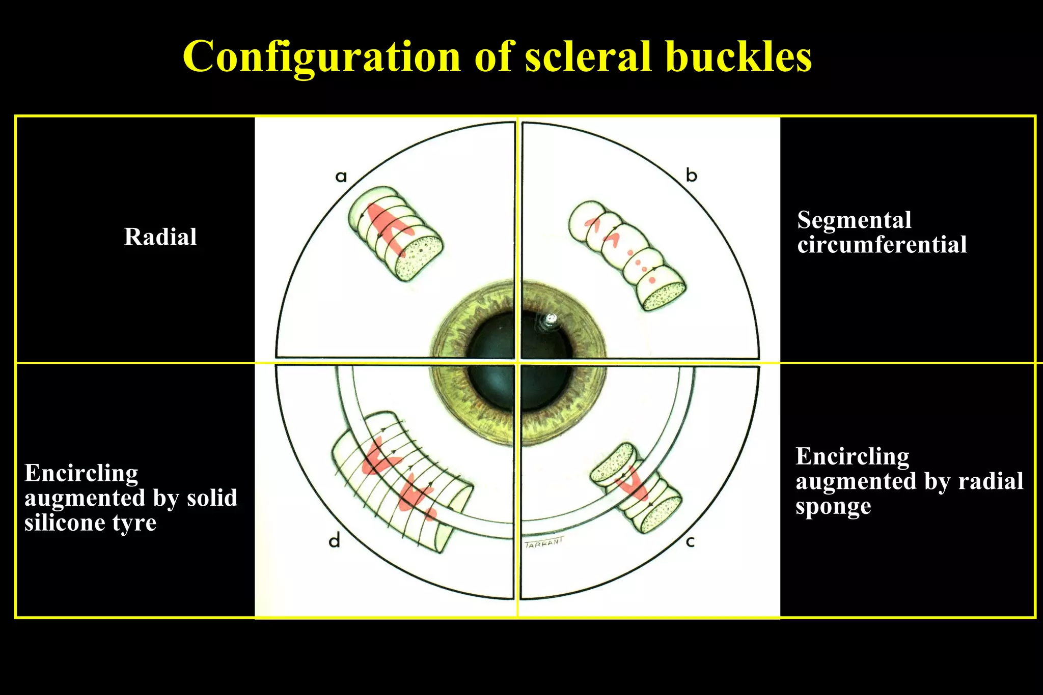 41 principles retinal detachment surgery | PPT