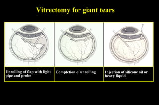 41 principles retinal detachment surgery | PPT