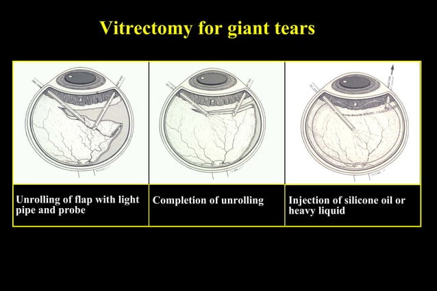 41 principles retinal detachment surgery | PPT