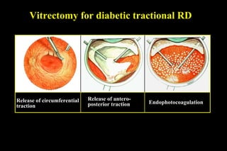 41 principles retinal detachment surgery | PPT