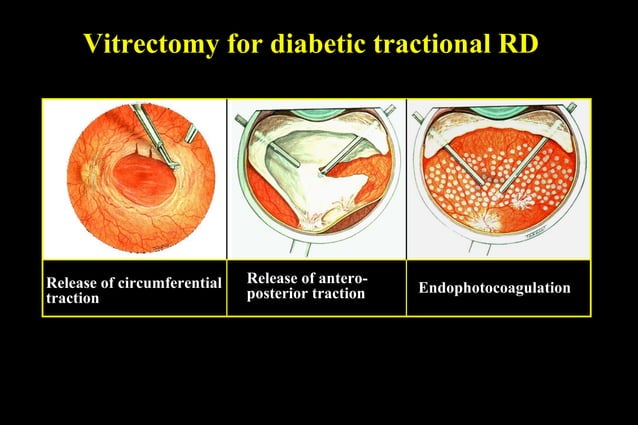 41 principles retinal detachment surgery | PPT