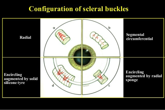 41 principles retinal detachment surgery