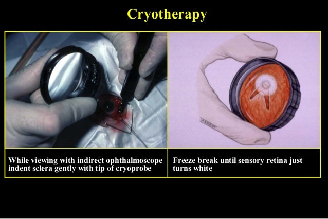 41 principles retinal detachment surgery