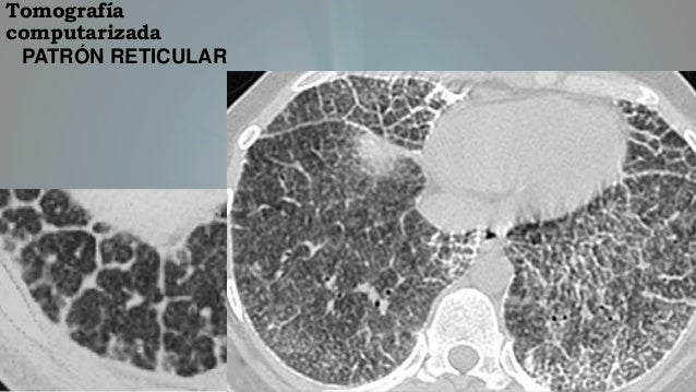 Imagenologia: Nodulo pulmonar solitario y enfermedades intersticiales