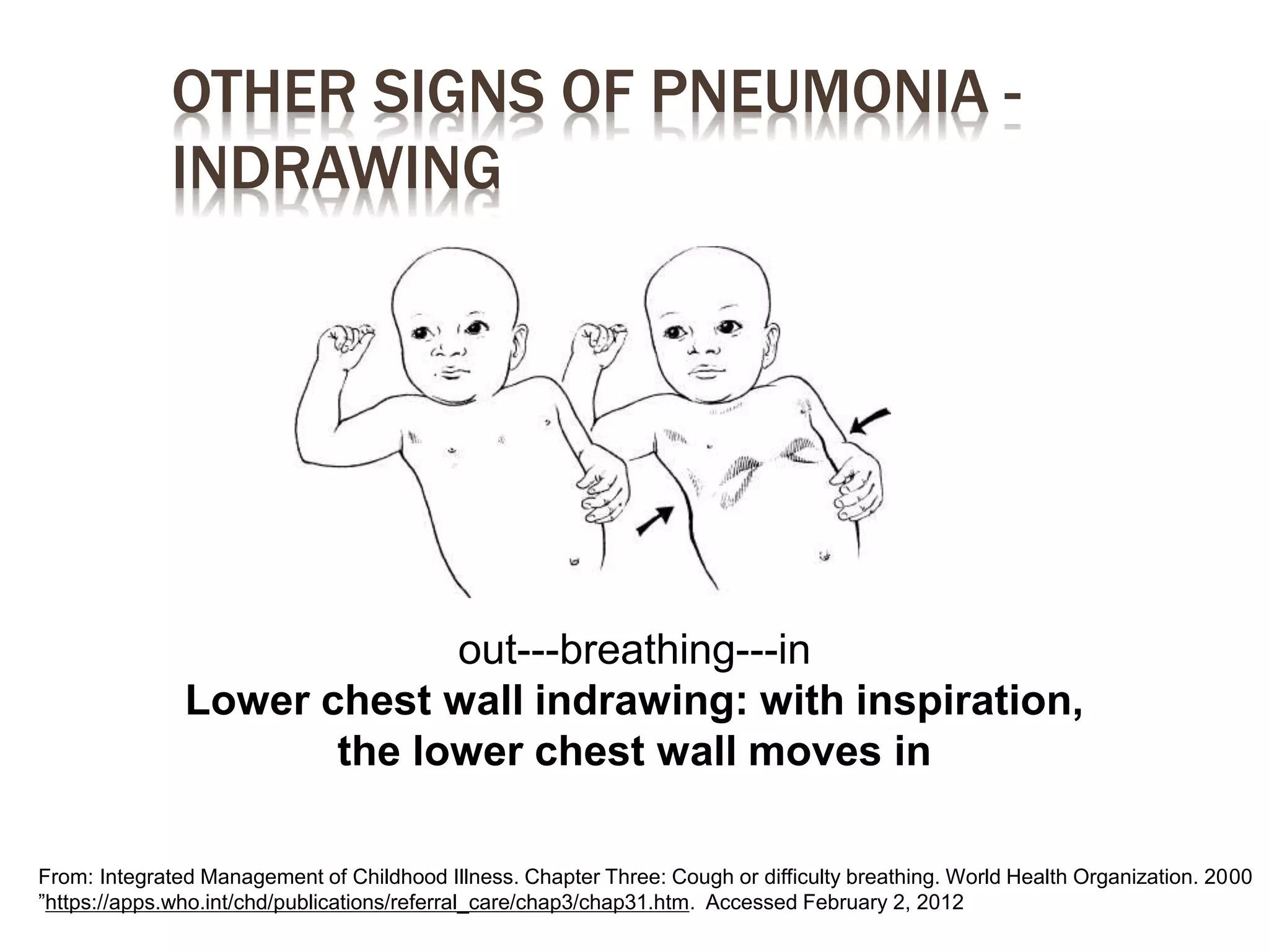 Pneumonia Pediatric | PPTX