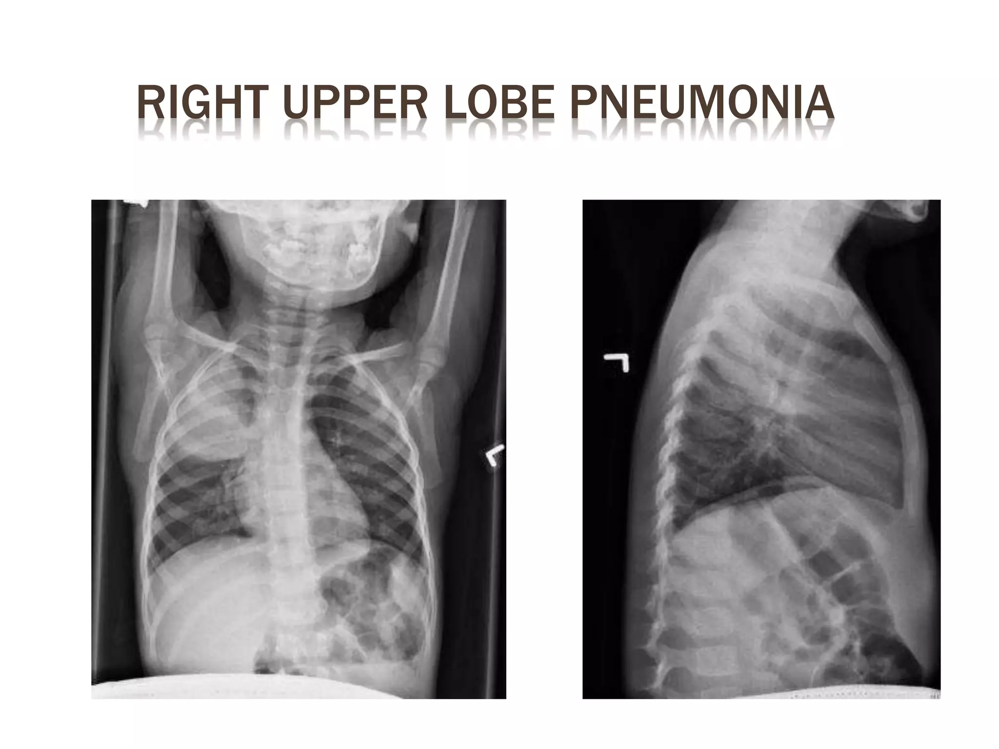 Pneumonia Pediatric | PPTX