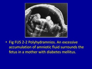 Polyhydramnios Ultrasound