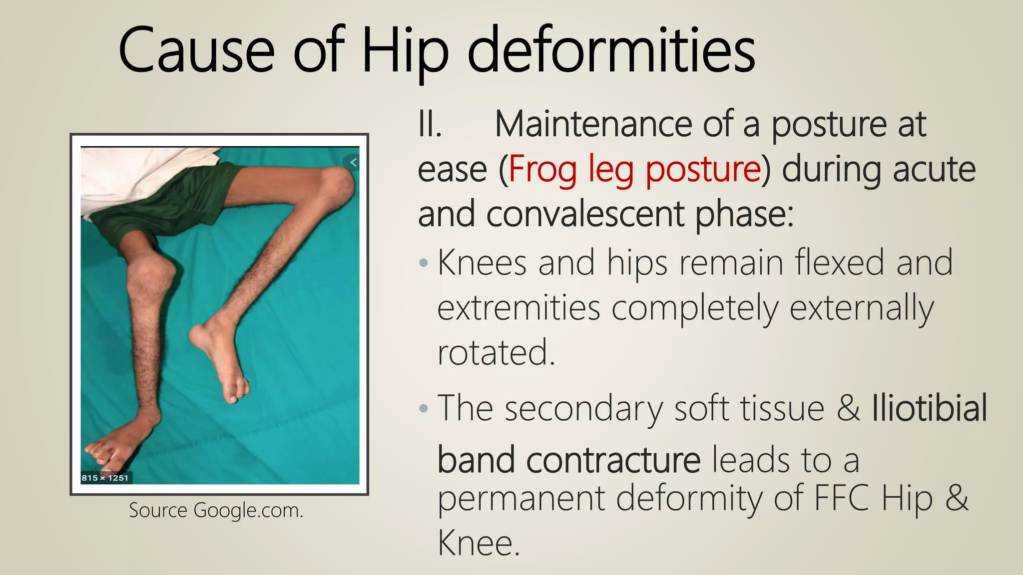 PostPolio Residual Paralysis part2 lower limb | PPTX