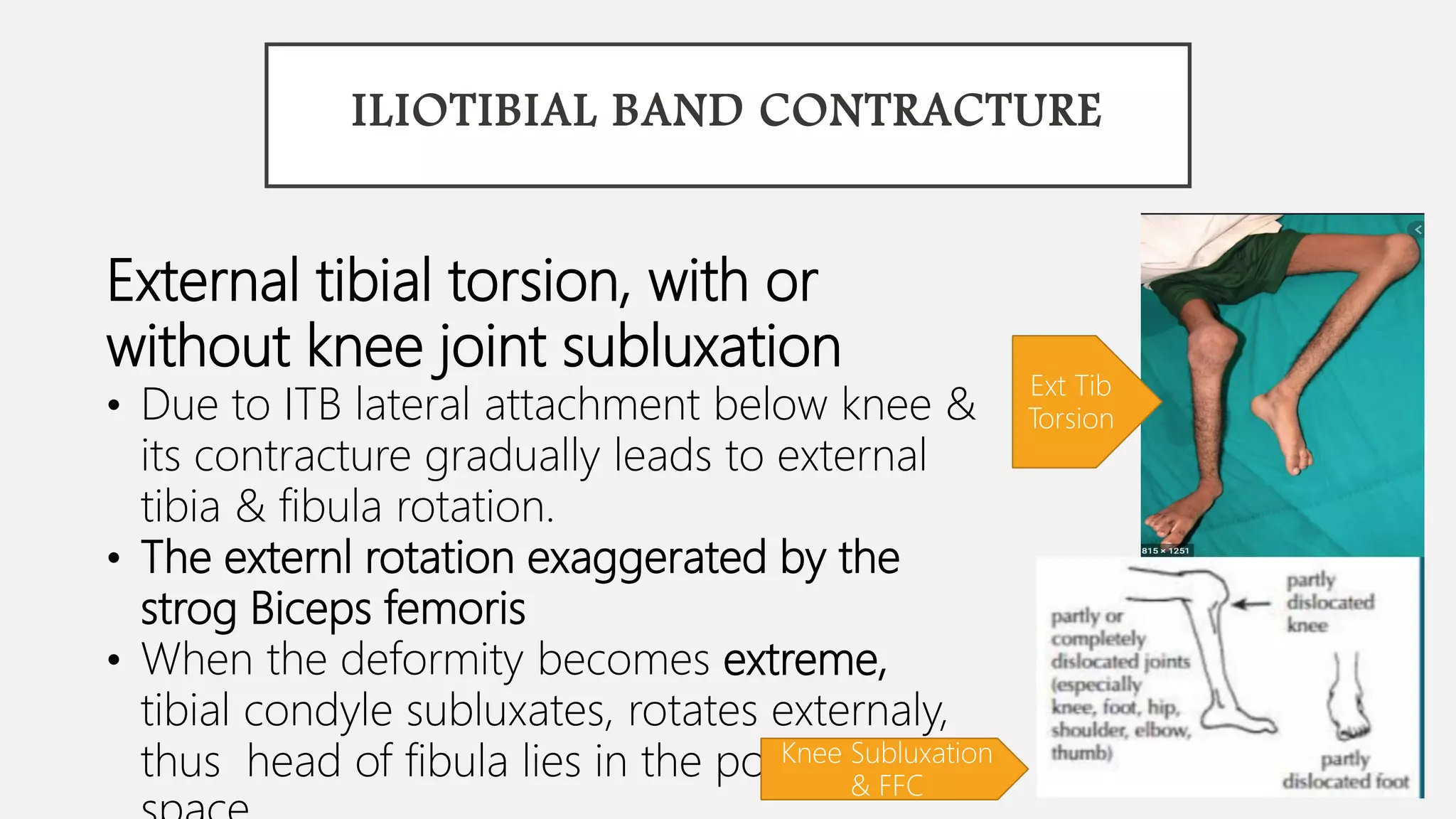 PostPolio Residual Paralysis part2 lower limb | PPTX