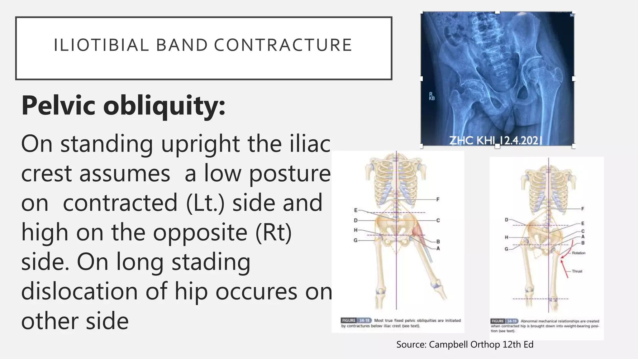 PostPolio Residual Paralysis part2 lower limb | PPTX