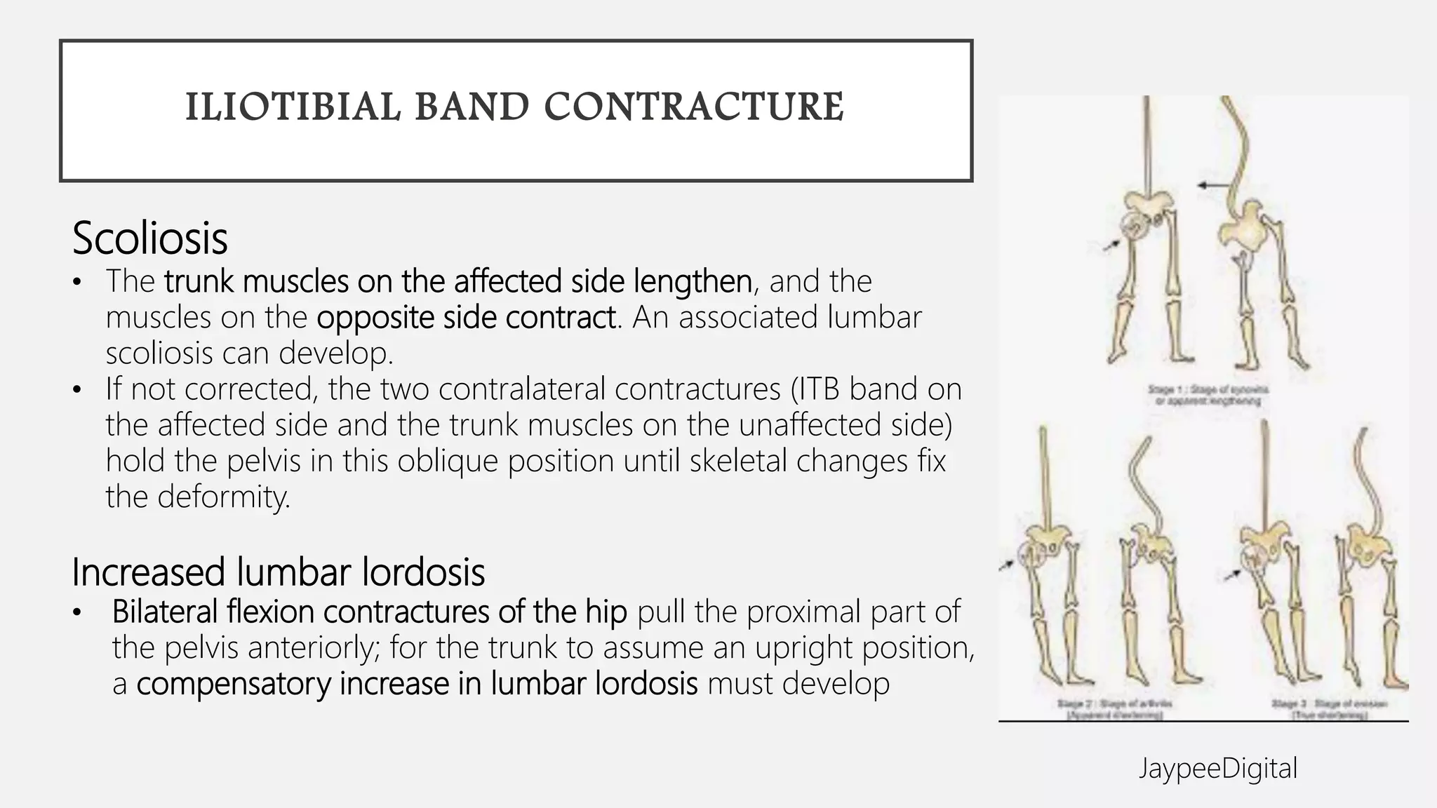 PostPolio Residual Paralysis part2 lower limb | PPTX