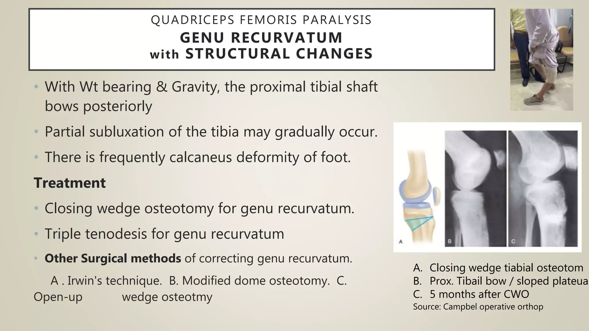 PostPolio Residual Paralysis part2 lower limb | PPTX