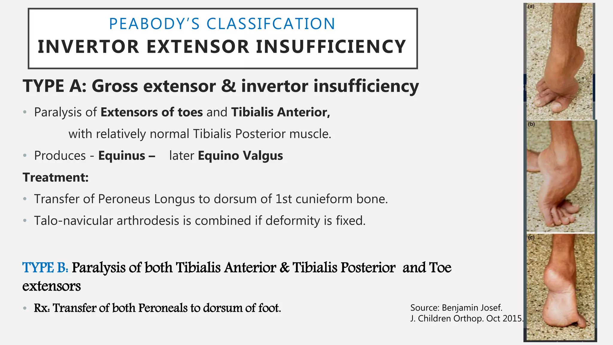 PostPolio Residual Paralysis part2 lower limb | PPTX