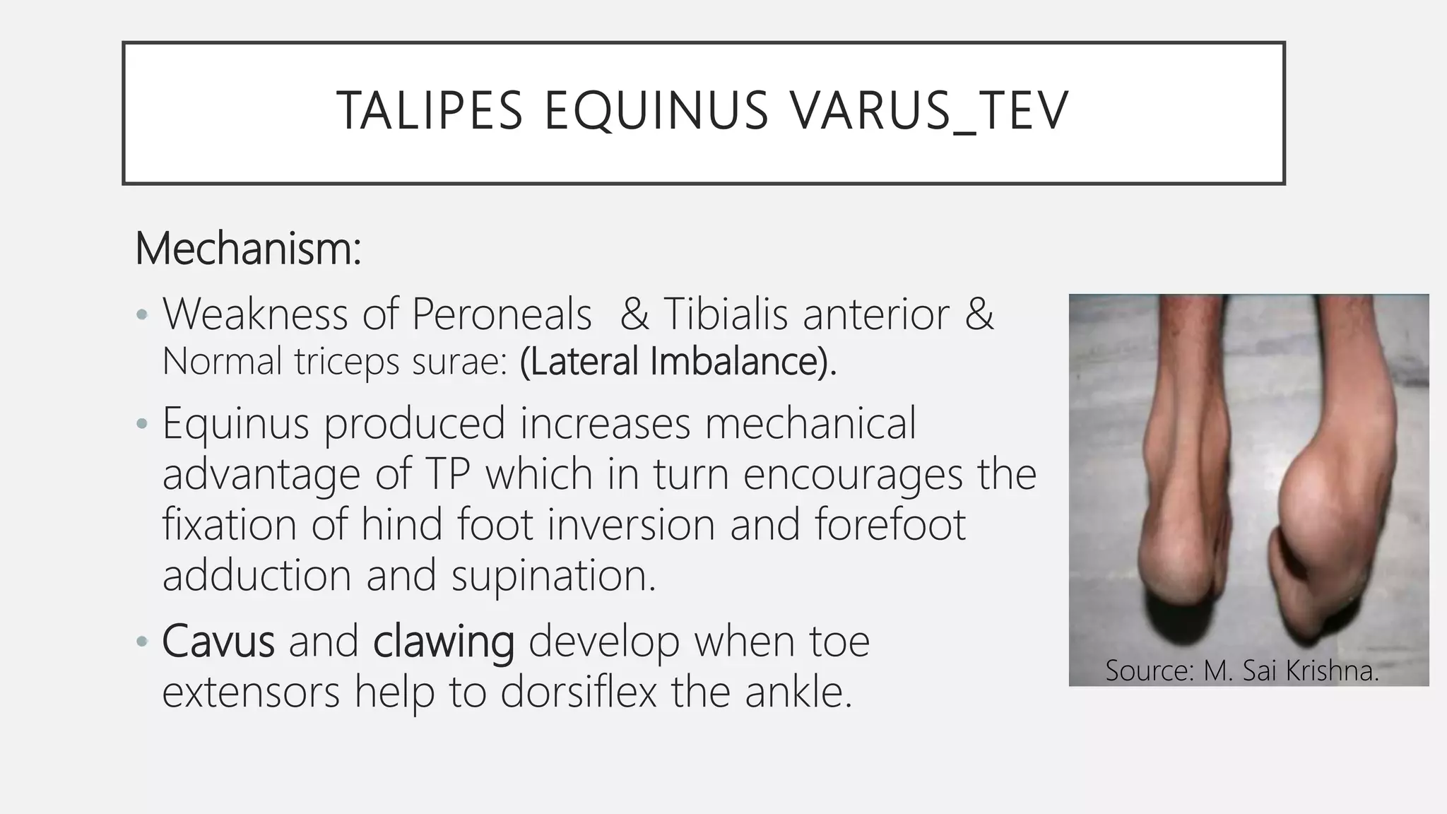 PostPolio Residual Paralysis part2 lower limb | PPTX