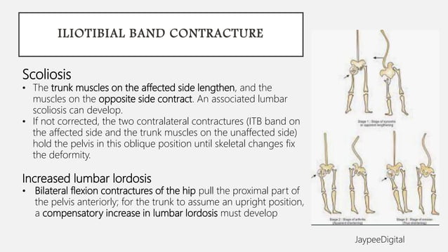 PostPolio Residual Paralysis part2 lower limb | PPT