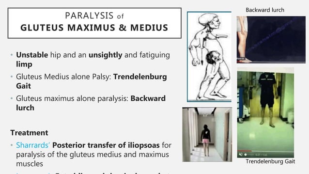 PostPolio Residual Paralysis part2 lower limb | PPT