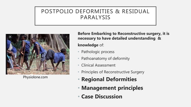 PostPolio Residual Paralysis part2 lower limb | PPT