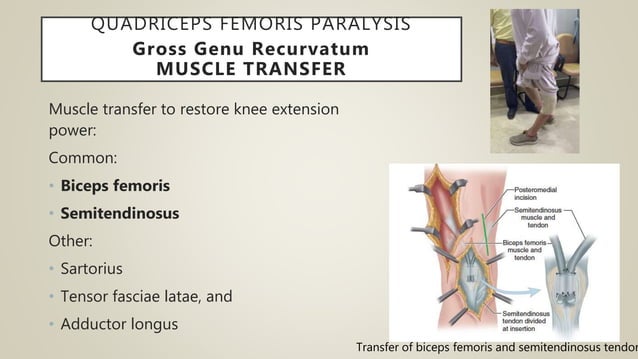 PostPolio Residual Paralysis part2 lower limb | PPT