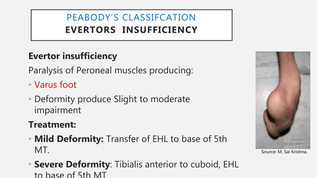 PostPolio Residual Paralysis part2 lower limb | PPT