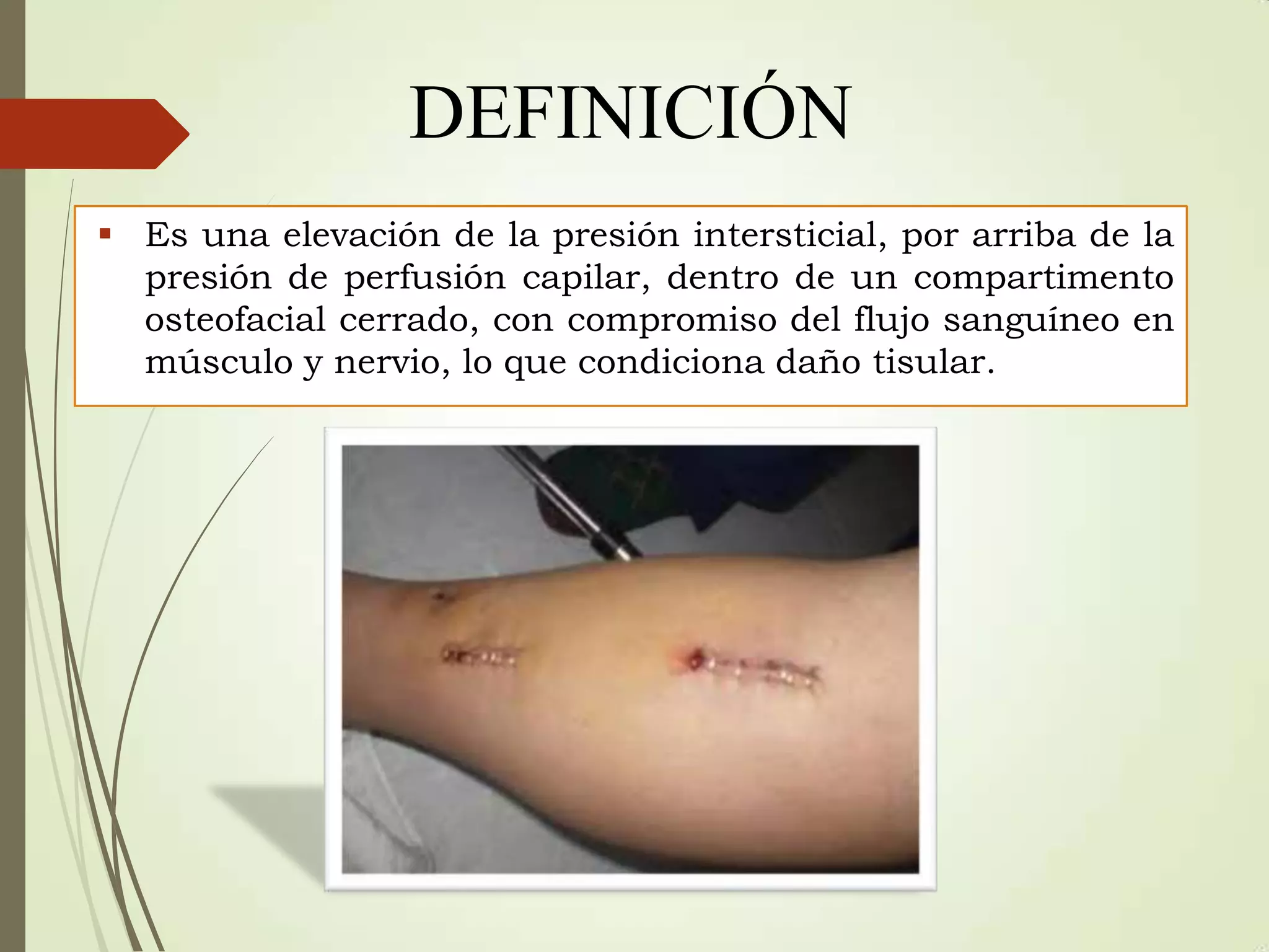 2 presentacion sindrome compartimental | PPTX