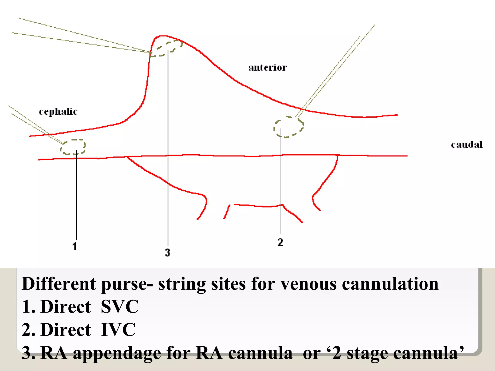 Open heart surgery | PPT