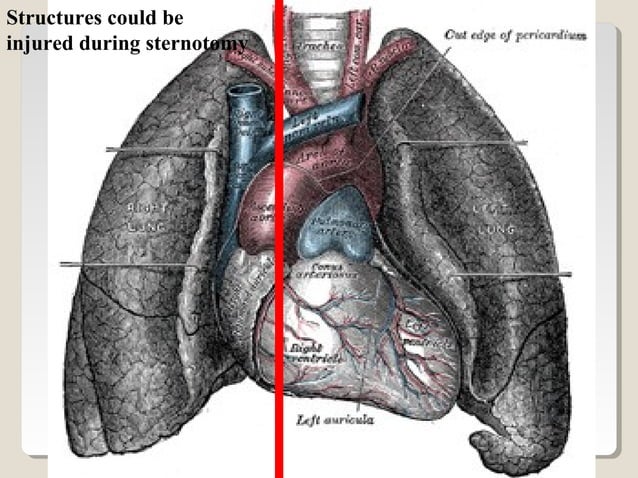 Open heart surgery | PPT | Heart and Cardiovascular Diseases | Diseases ...