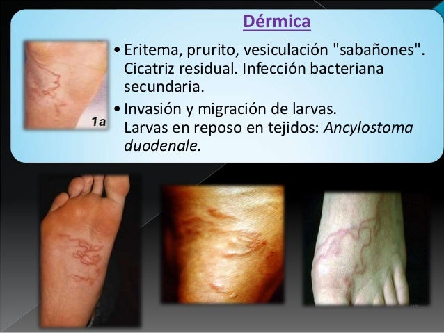 Clase 10 uncinariasis