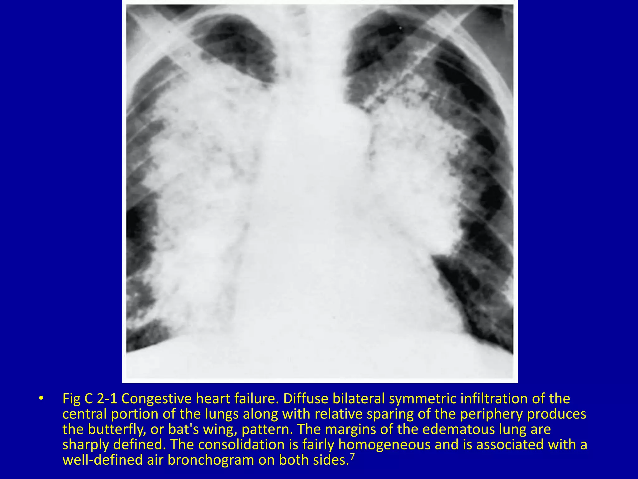 2 pulmonary edema pattern (symmetric bilateral alveolar | PPTX