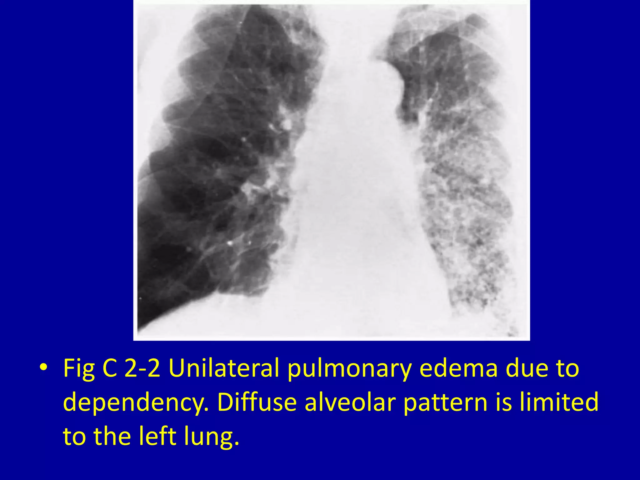 2 pulmonary edema pattern (symmetric bilateral alveolar | PPTX