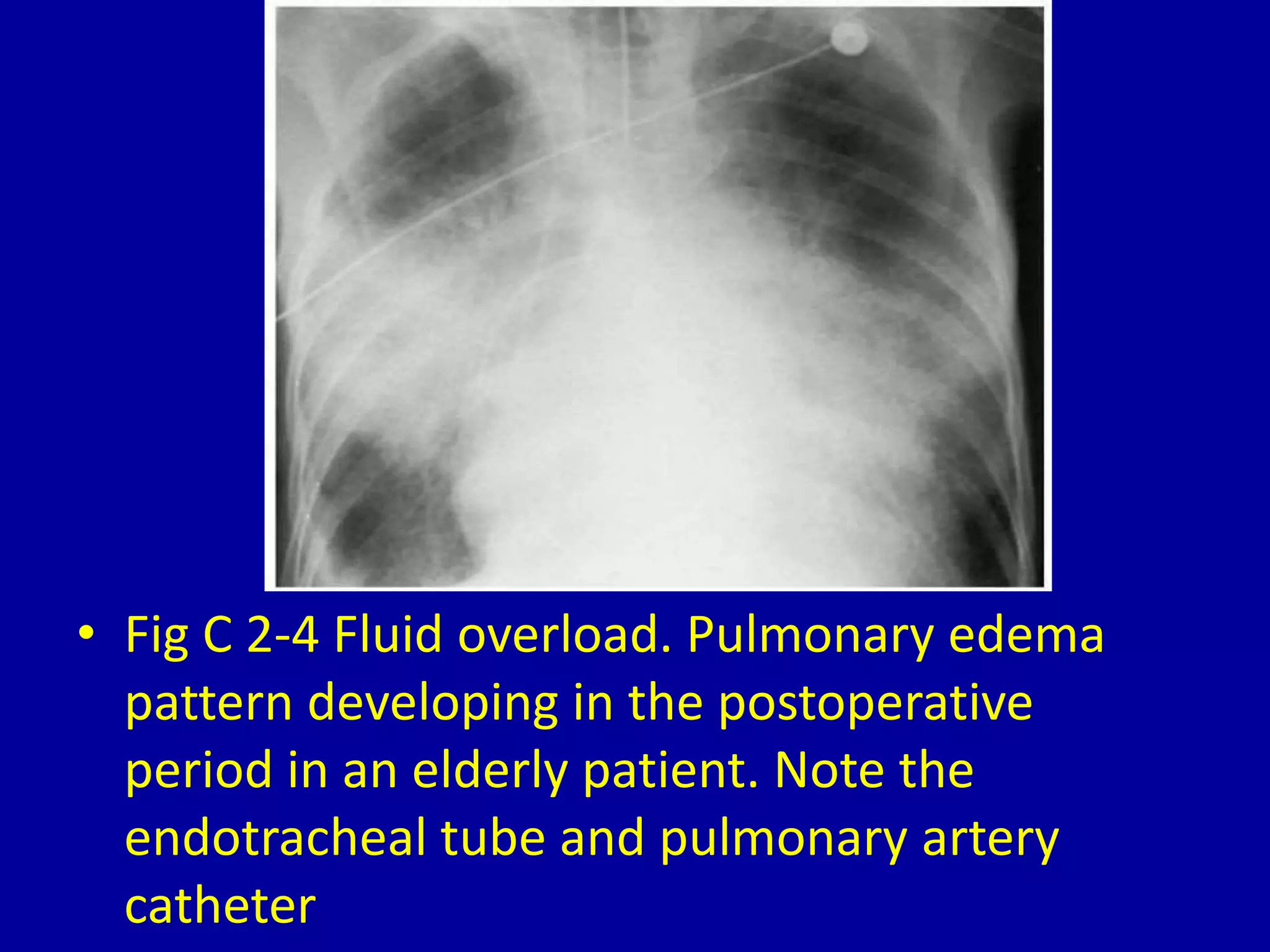 2 pulmonary edema pattern (symmetric bilateral alveolar | PPT