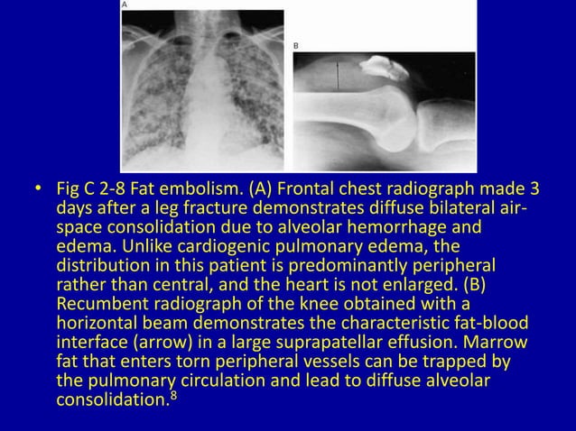 2 pulmonary edema pattern (symmetric bilateral alveolar | PPT