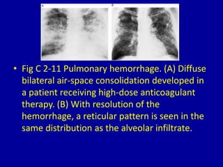 2 pulmonary edema pattern (symmetric bilateral alveolar | PPTX