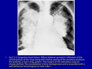 Pulmonary Edema X Ray Butterfly Pattern