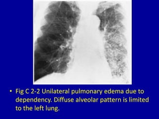 Alveolar Pulmonary Edema