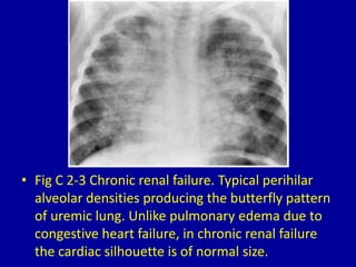 Pulmonary Edema X Ray Butterfly Pattern