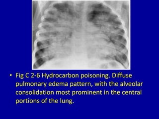 Pulmonary Edema X Ray Butterfly Pattern