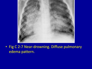 2 pulmonary edema pattern (symmetric bilateral alveolar | PPTX