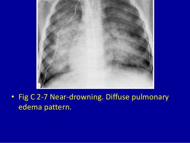 2 pulmonary edema pattern (symmetric bilateral alveolar