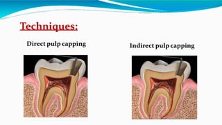 Pulp capping agents and procedures by Dr Islam Alsakkaf | PPTX
