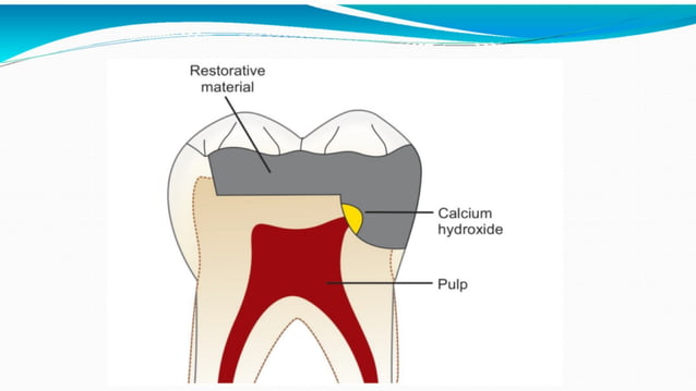 Pulp capping agents and procedures by Dr Islam Alsakkaf | PPTX