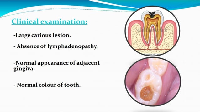 Pulp capping agents and procedures by Dr Islam Alsakkaf | PPTX